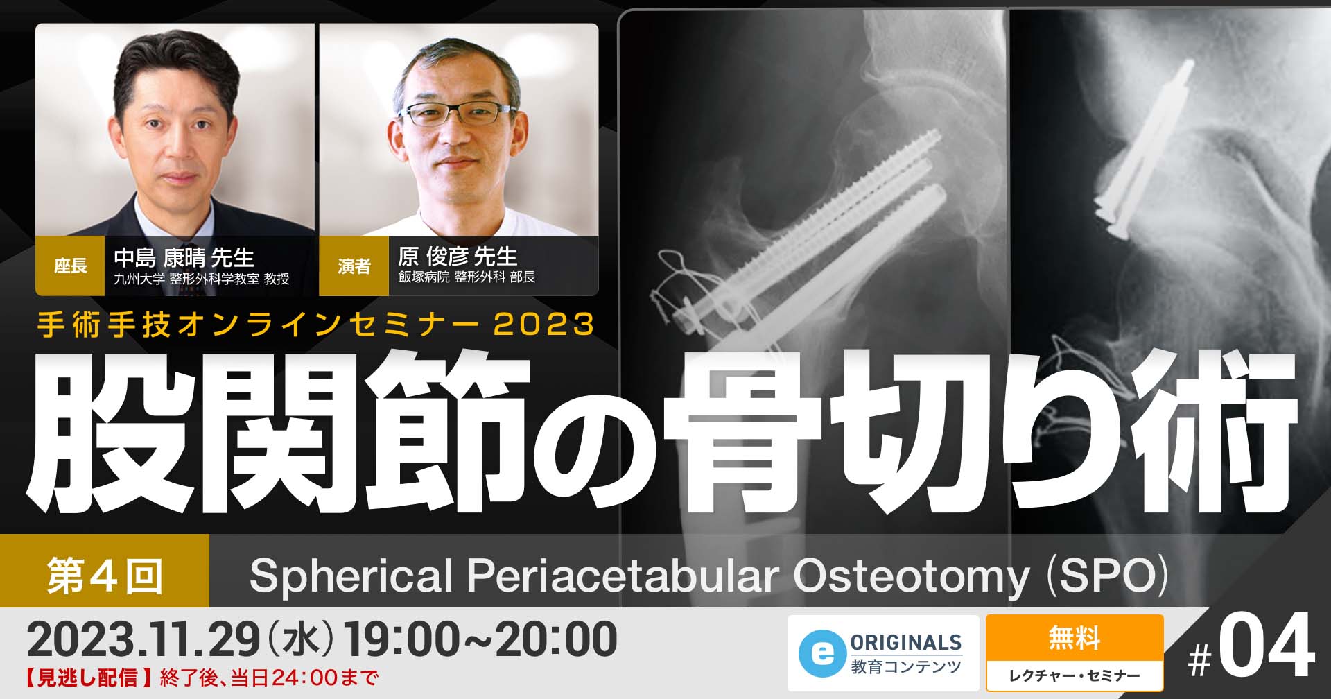 LIVE: Spherical Periacetabular Osteotomy (SPO) | Orthopedics | e ...