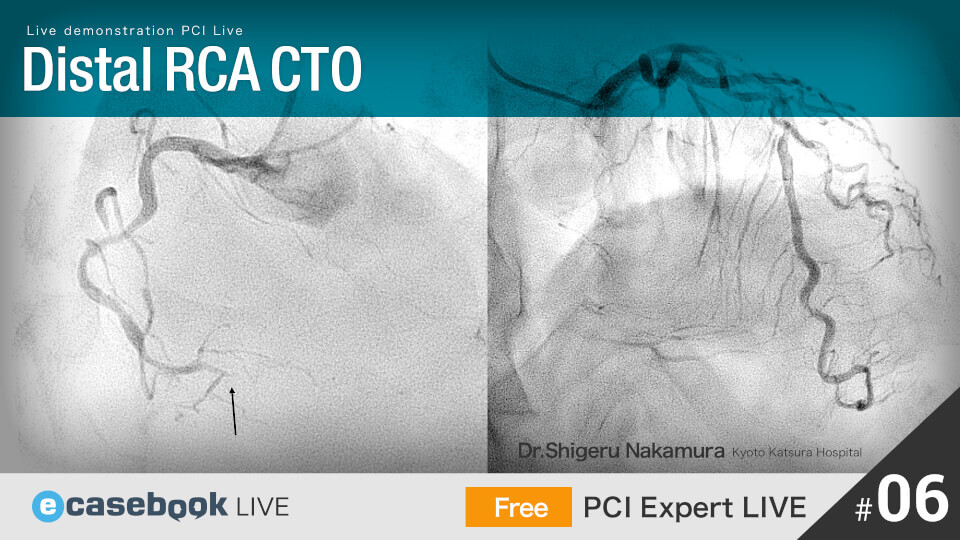 VIDEO: Distal RCA CTO | Cardiology | e-casebook LIVE