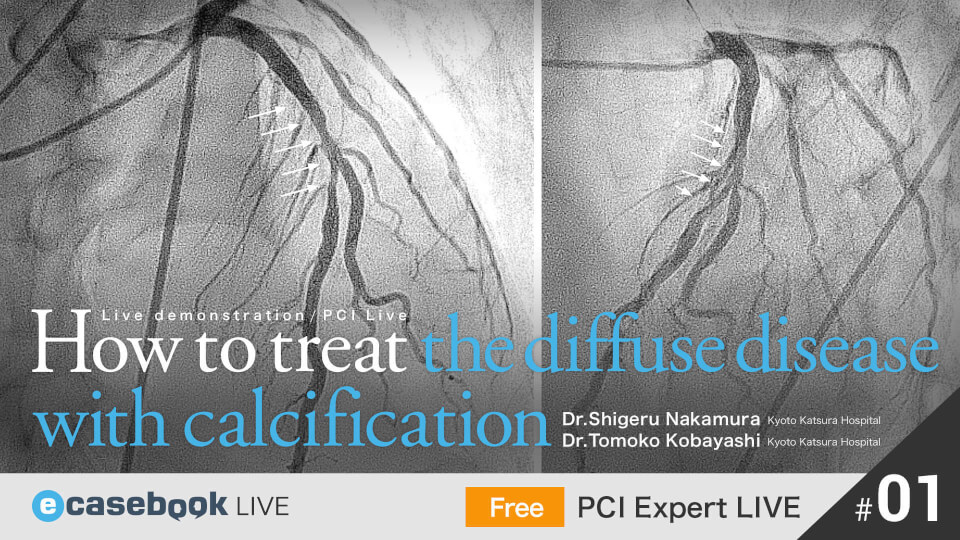 VIDEO: How to treat the diffuse disease with calcification | Cardiology ...