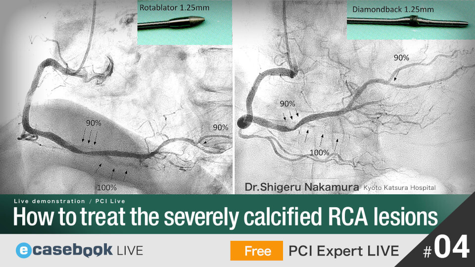 VIDEO: How to treat the severely calcified RCA lesions | Cardiology | e ...